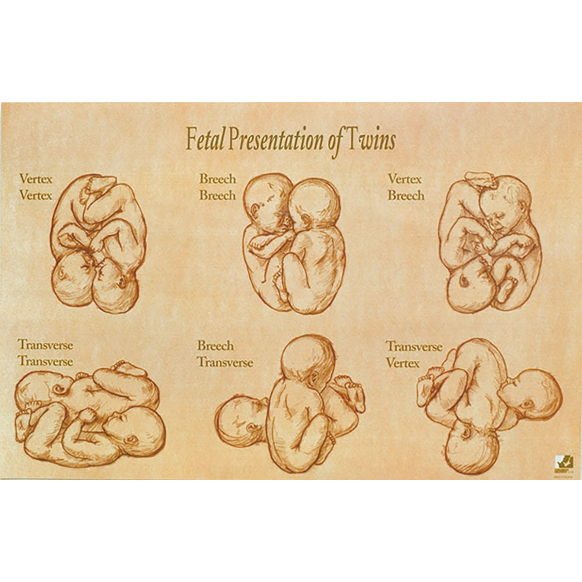 Fetal Development & Presentation of Twins Chart